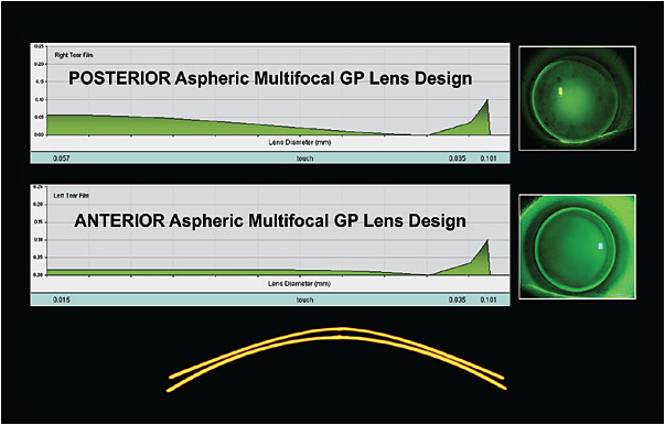 Contact Lens Spectrum | PentaVision