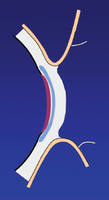 Contact Lens Spectrum | PentaVision