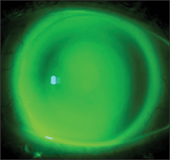 Contact Lens Spectrum | PentaVision