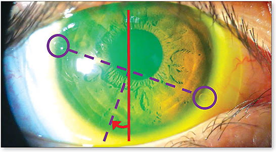 Contact Lens Spectrum | PentaVision
