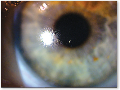 Contact Lens Spectrum | PentaVision