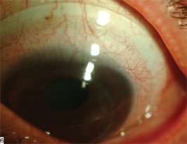Contact Lens Spectrum | PentaVision
