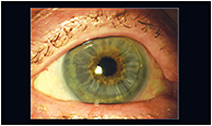Contact Lens Spectrum | PentaVision