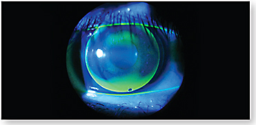 Contact Lens Spectrum | PentaVision