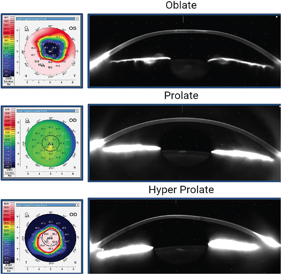 Contact Lens Spectrum | PentaVision