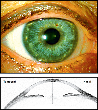 Contact Lens Spectrum | PentaVision