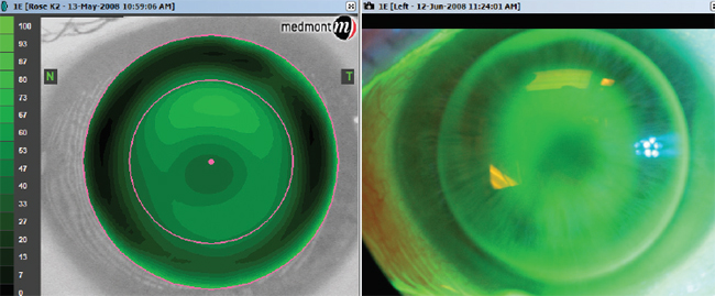 Contact Lens Spectrum | PentaVision