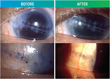 Contact Lens Spectrum | PentaVision