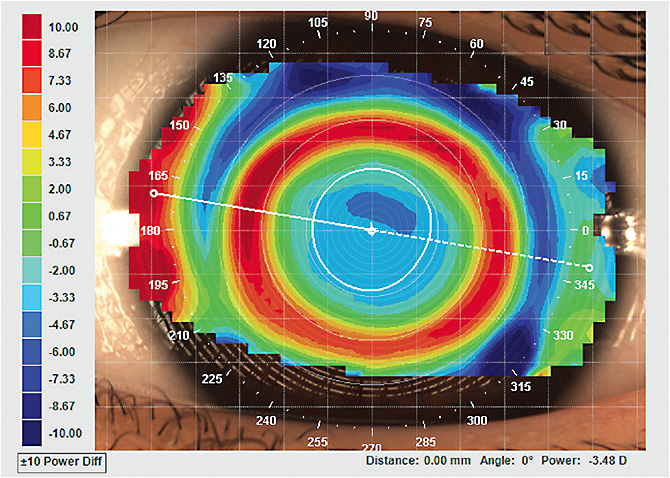 Contact Lens Spectrum | PentaVision