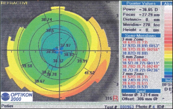 Contact Lens Spectrum | PentaVision