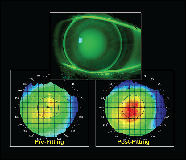 Contact Lens Spectrum | PentaVision