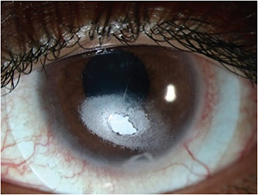 Contact Lens Spectrum | PentaVision