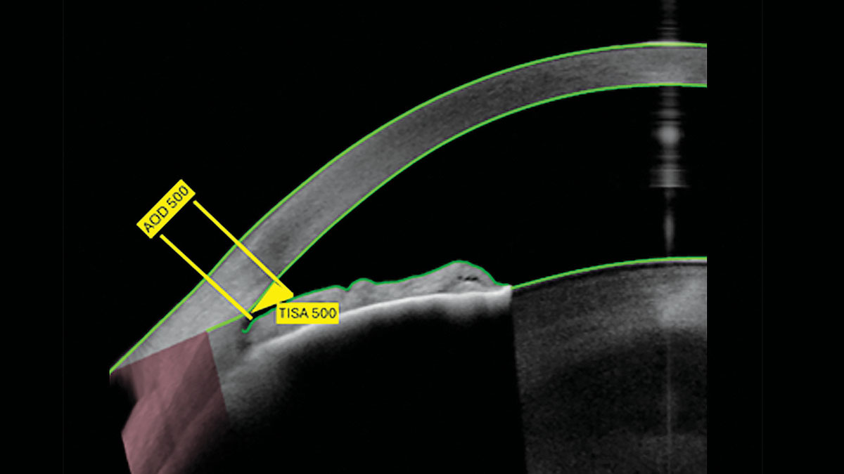 The Scleral Lens Vault: The Eye Under Pressure | Contact Lens Spectrum