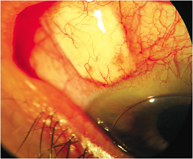 Contact Lens Spectrum | PentaVision