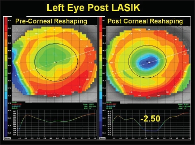 Contact Lens Spectrum | PentaVision