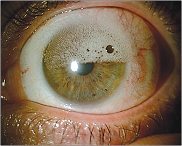 Contact Lens Spectrum | PentaVision
