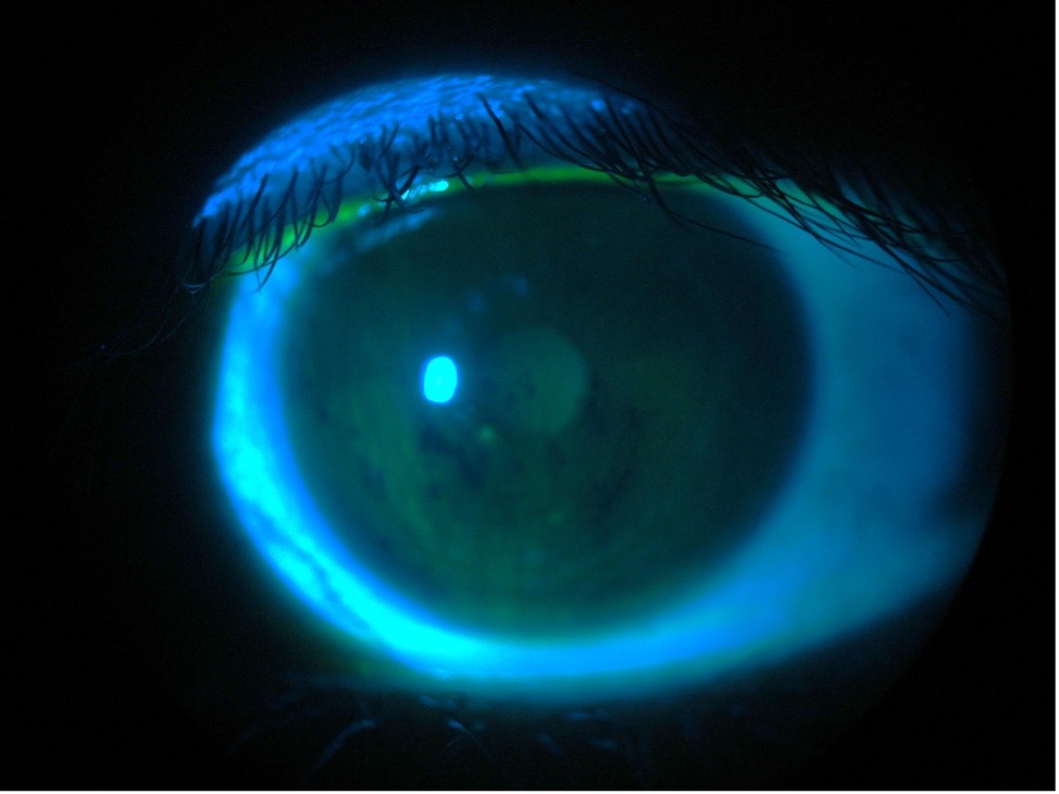 ONLINE PHOTO DIAGNOSIS | Contact Lens Spectrum