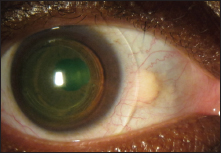 Contact Lens Spectrum | PentaVision