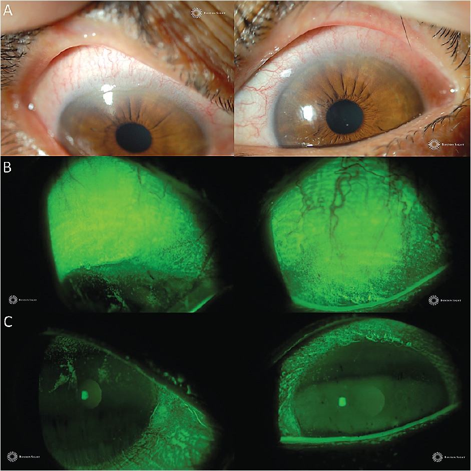 Contact Lens Spectrum | PentaVision