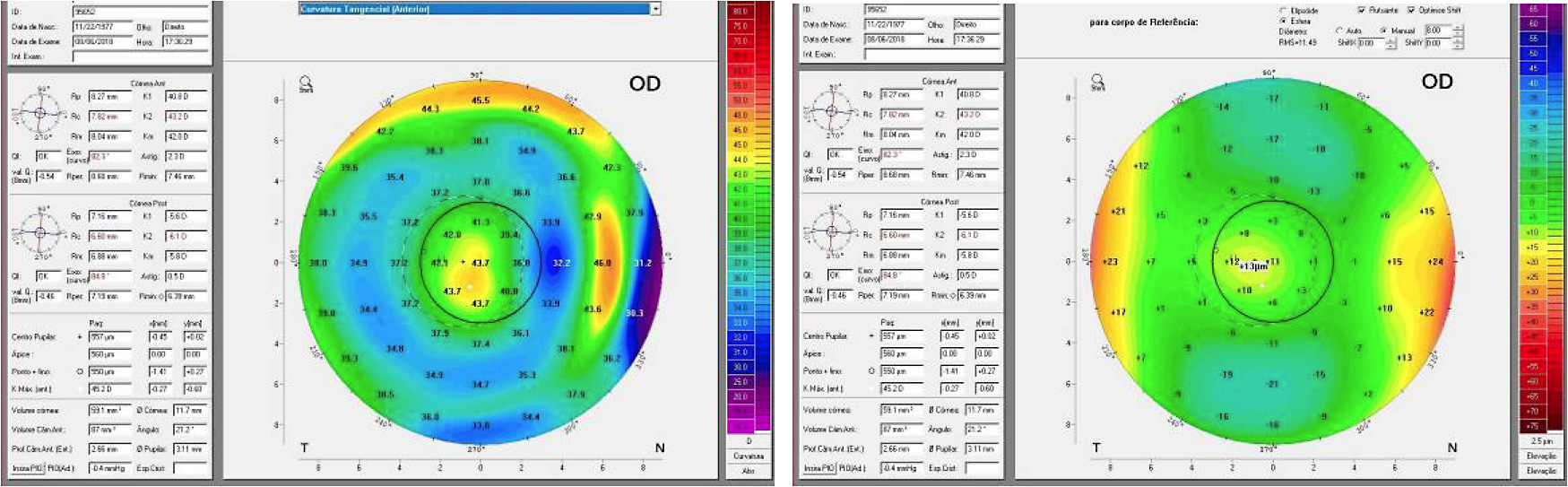 Contact Lens Spectrum | PentaVision