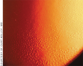 Contact Lens Spectrum | PentaVision