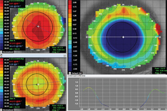 Contact Lens Spectrum | PentaVision