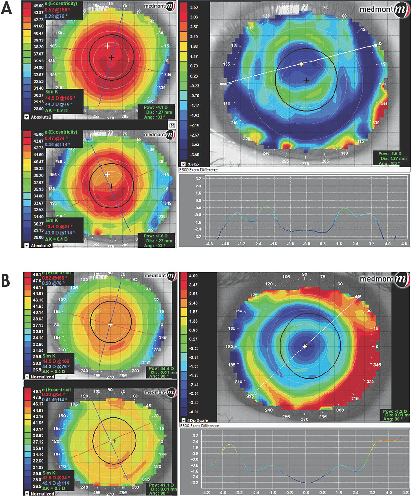 Contact Lens Spectrum | PentaVision