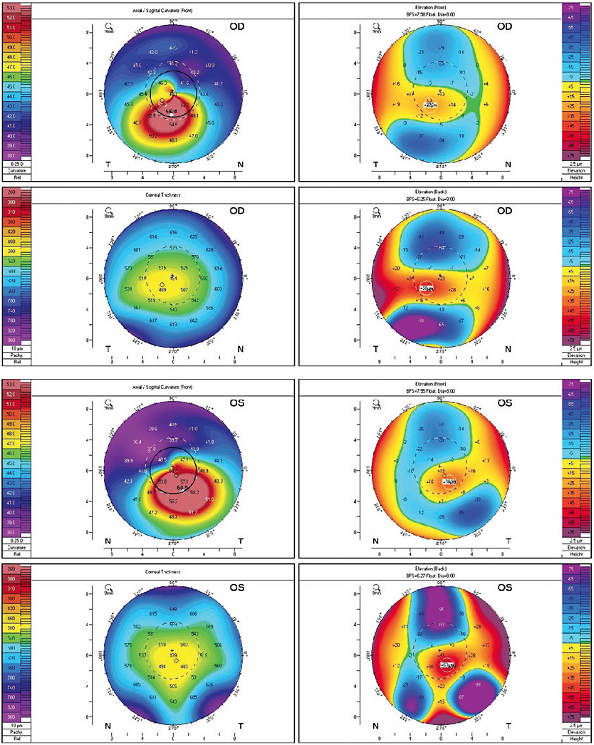 Contact Lens Spectrum | PentaVision