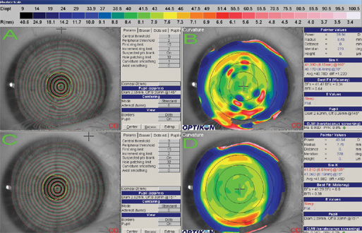 Contact Lens Spectrum | PentaVision