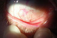 Contact Lens Spectrum | PentaVision