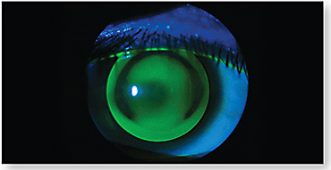 Contact Lens Spectrum | PentaVision
