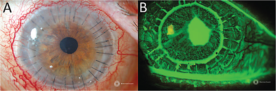 Contact Lens Spectrum | PentaVision