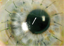 Contact Lens Spectrum | PentaVision