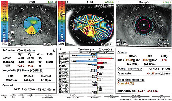 Contact Lens Spectrum | PentaVision