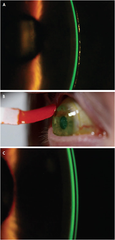 Contact Lens Spectrum | PentaVision