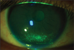 Contact Lens Spectrum | PentaVision