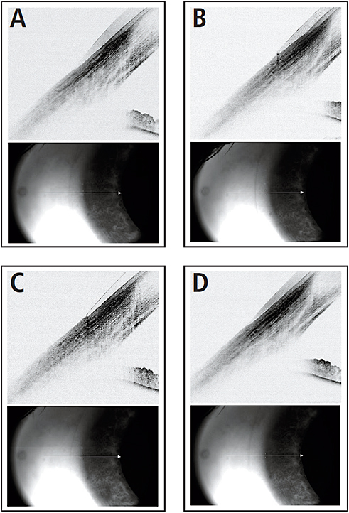 Contact Lens Spectrum | PentaVision