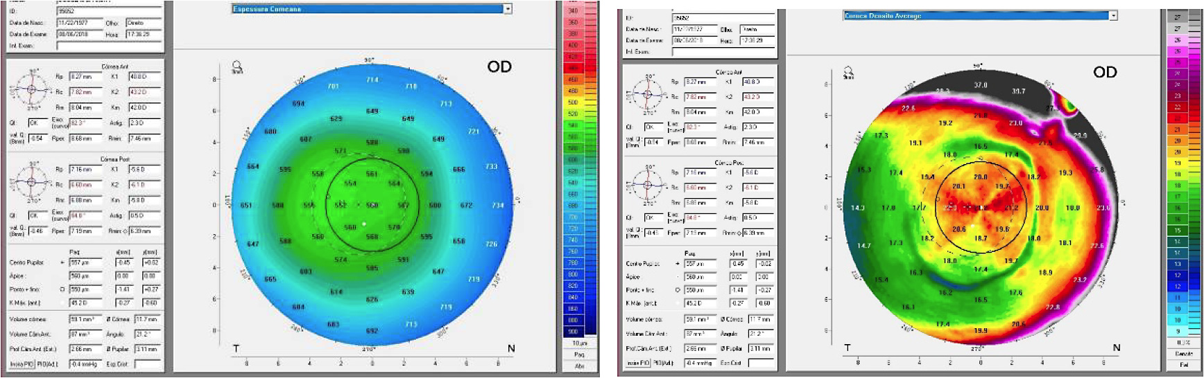 Contact Lens Spectrum | PentaVision