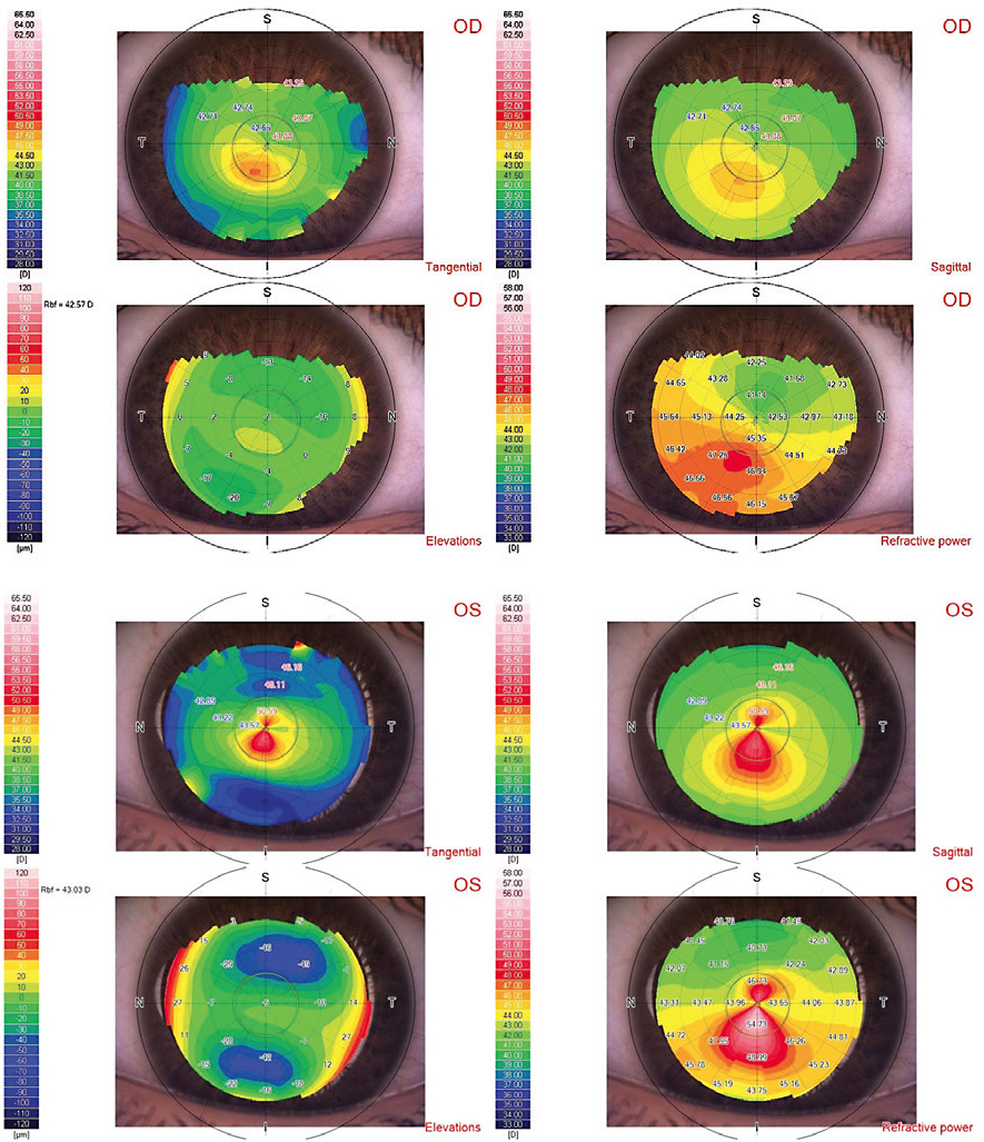 Contact Lens Spectrum | PentaVision