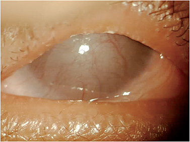 Contact Lens Spectrum | PentaVision
