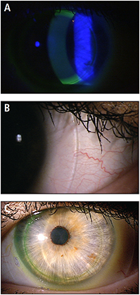 Contact Lens Spectrum | PentaVision