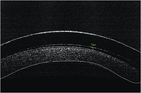 Contact Lens Spectrum | PentaVision