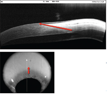 Contact Lens Spectrum | PentaVision