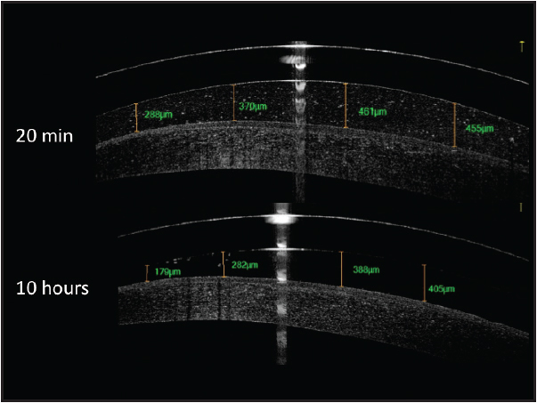 Contact Lens Spectrum | PentaVision