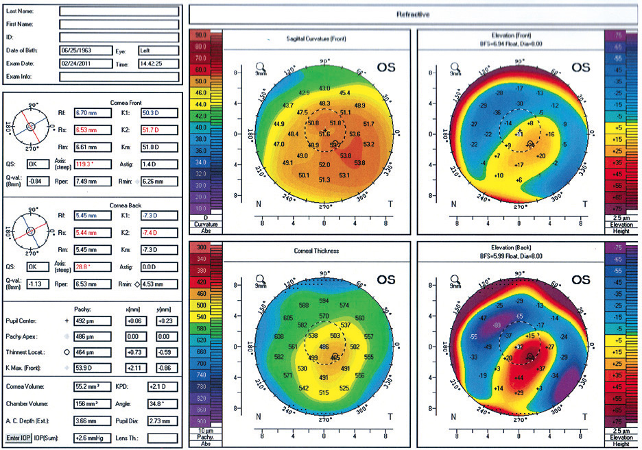 Contact Lens Spectrum | PentaVision
