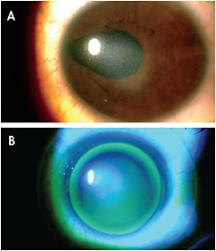 Contact Lens Spectrum | PentaVision