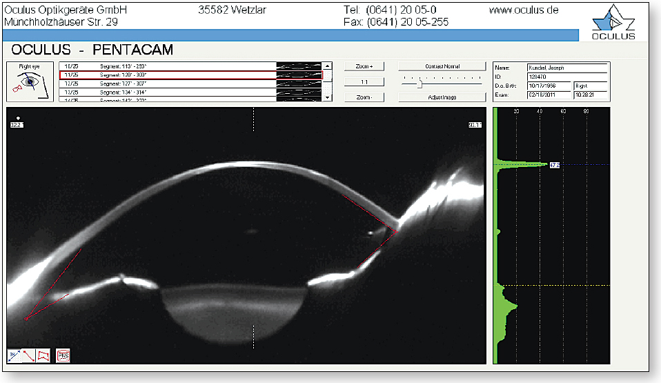 Contact Lens Spectrum | PentaVision