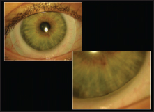 Contact Lens Spectrum | PentaVision