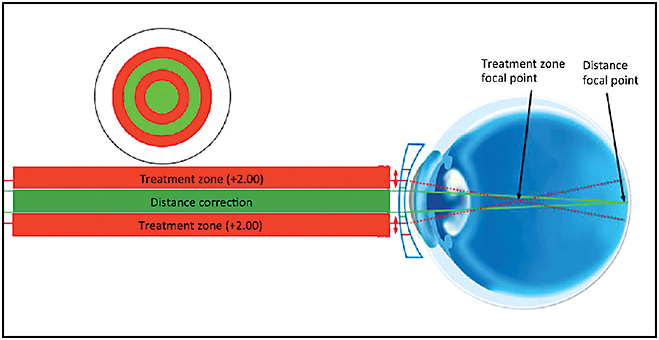 Contact Lens Spectrum | PentaVision