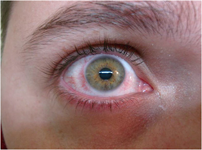 Contact Lens Spectrum | PentaVision